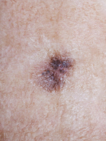 Skin Cancer | Heartland Dermatology
